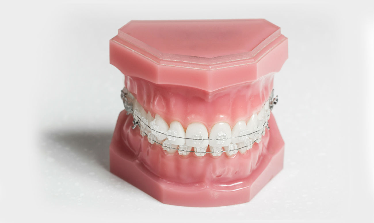 Брекеты Inspire Ice — фото, цена, отзывы на Startsmile.ru