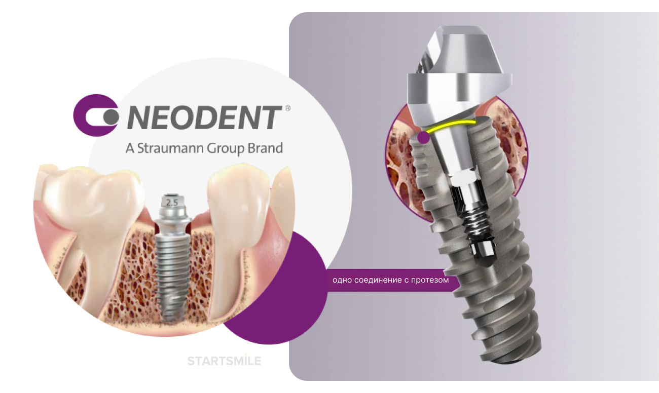 Импланты Неодент (Neodent) - плюсы и минусы, сравнение с конкурентами