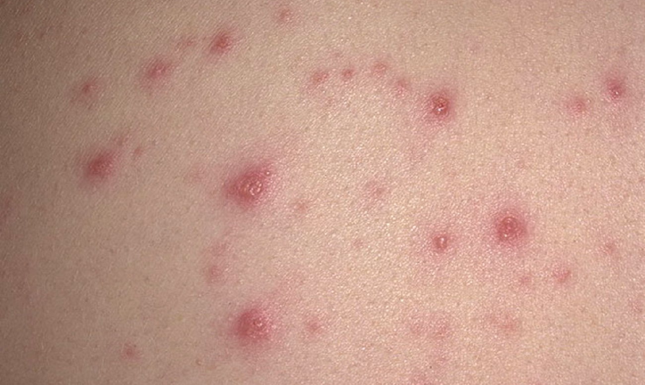 Петехии — что это такое, причины, симптомы, лечение — Startsmile