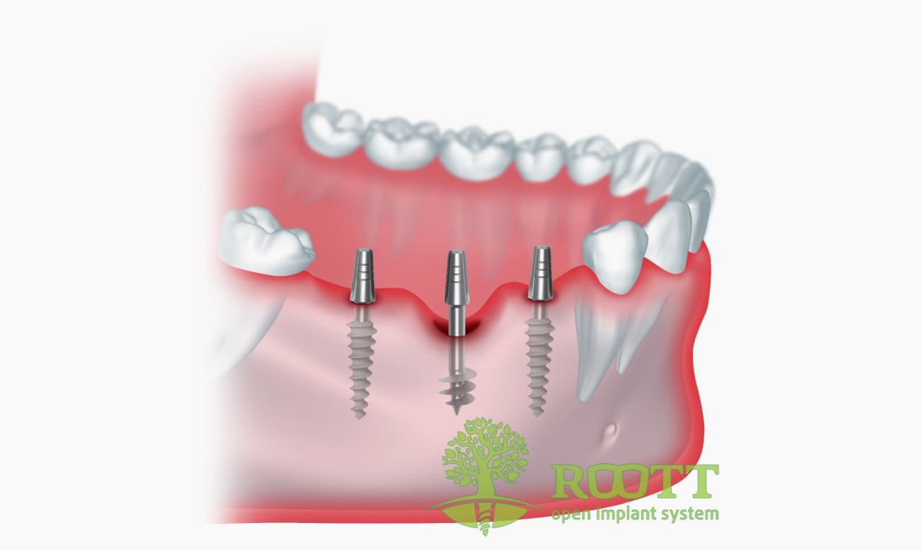 Зубные импланты Roott (Швейцария) — вся правда о рисках, отзывы ...