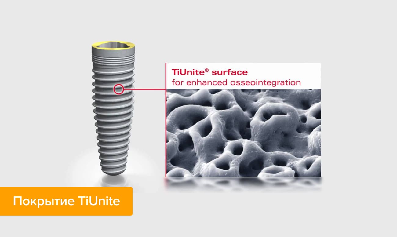 Зубные импланты Nobel Biocare — установка, отзывы пациентов, страна ...